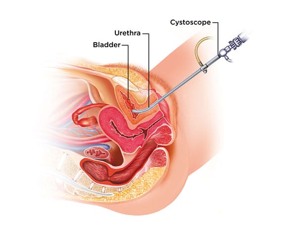Diagnostic Cystoscopy – Indo Taj Medical Center Diagnostic Cystoscopy – Indo Taj Medical Center